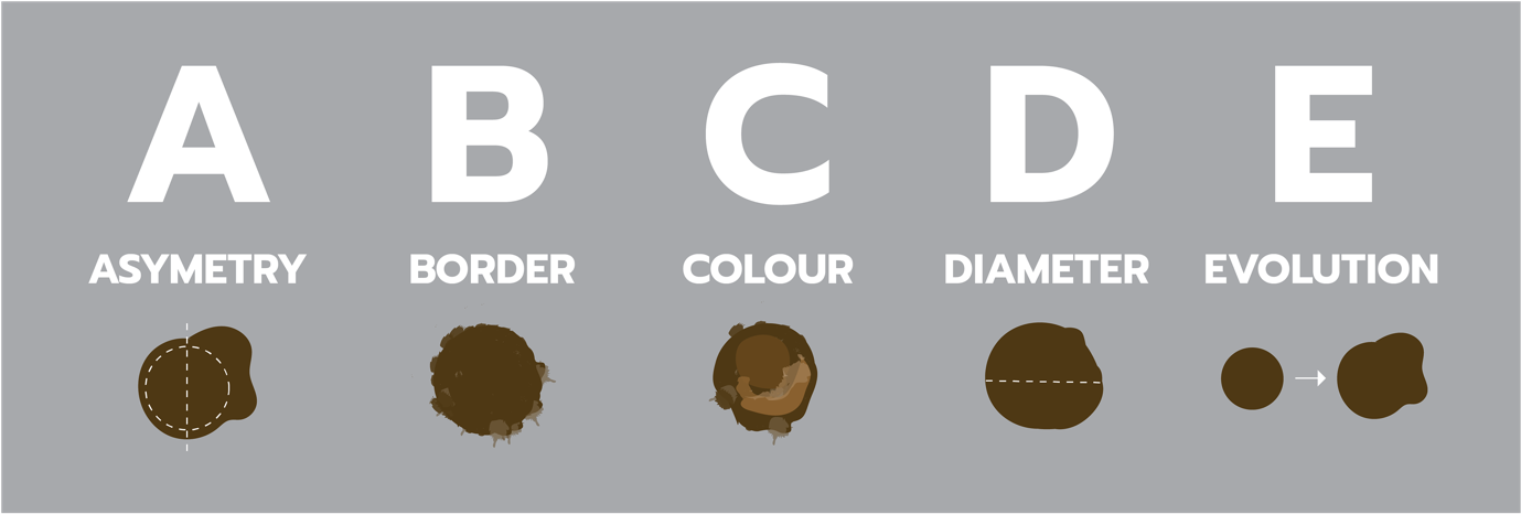 Skin Cancer in Ireland - Breakthrough Cancer ResearchBreakthrough ...