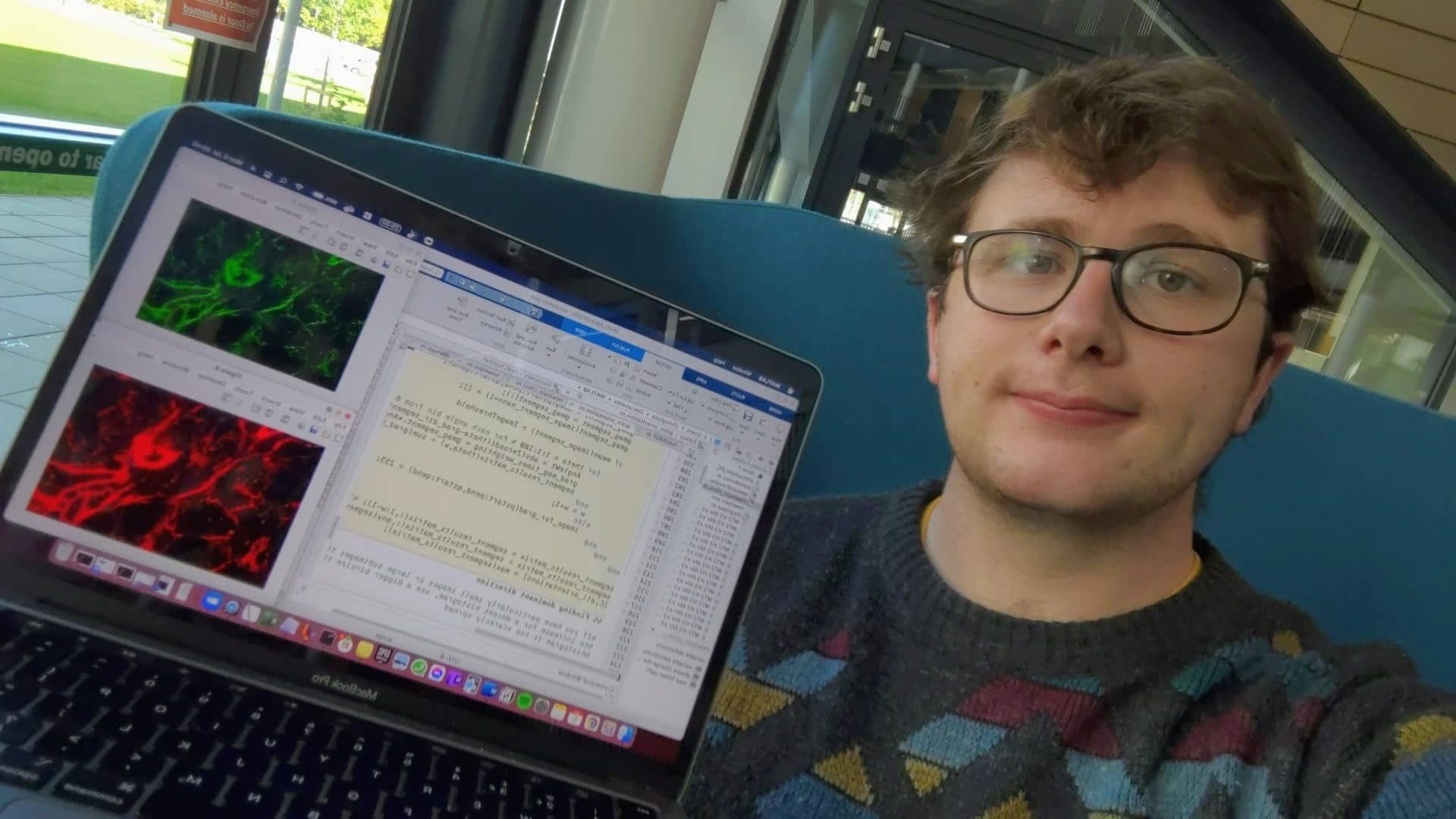 A Correlative Assessment of the role of Stroma Mechanics in Pancreatic ...